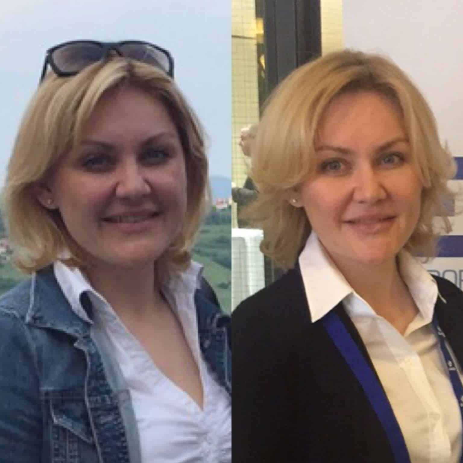 Injekcijska lipoliza - Raztapljanje maščobnih oblog - Dermatologija.si