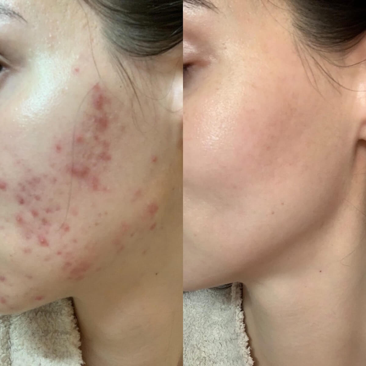 Dermatolog za akne - Dermatologija.si
